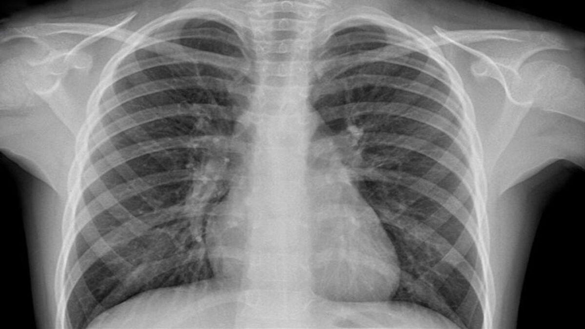 El daño pulmonar sigue estando presente un año después de pasar la ...